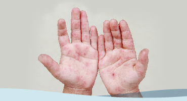 Prevent HFMD Spread at Home: What to Do If Your Child Has It